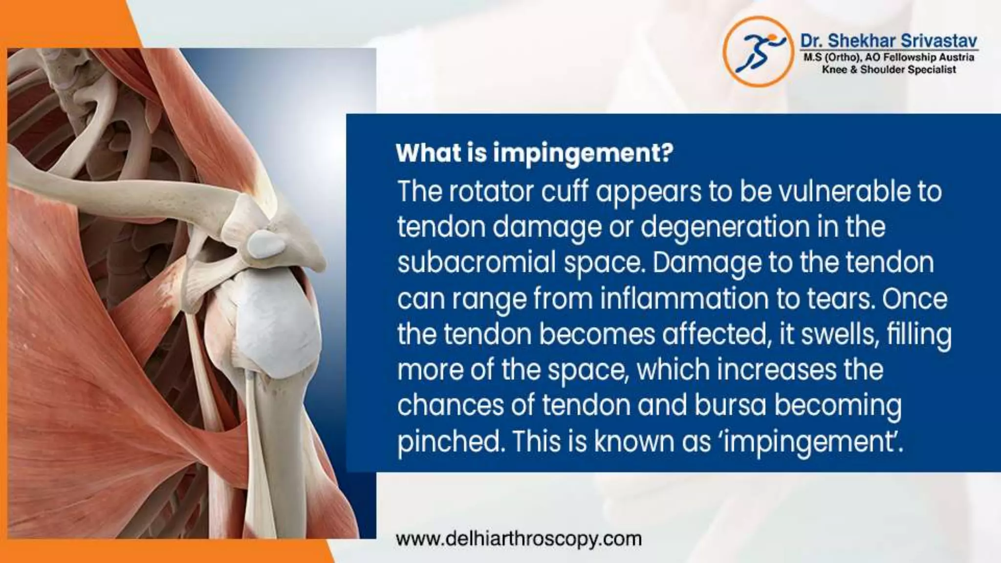 Arthroscopic Subacromial Decompression { Best Shoulder Arthroscopy ...