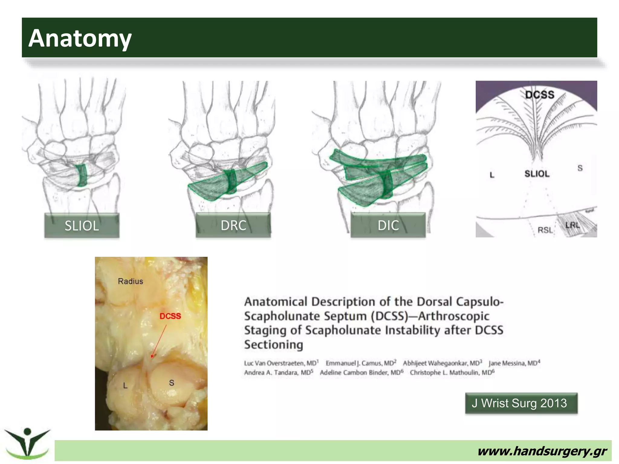 Arthroscopic treatment of dorsal wrist ganglions | PPT