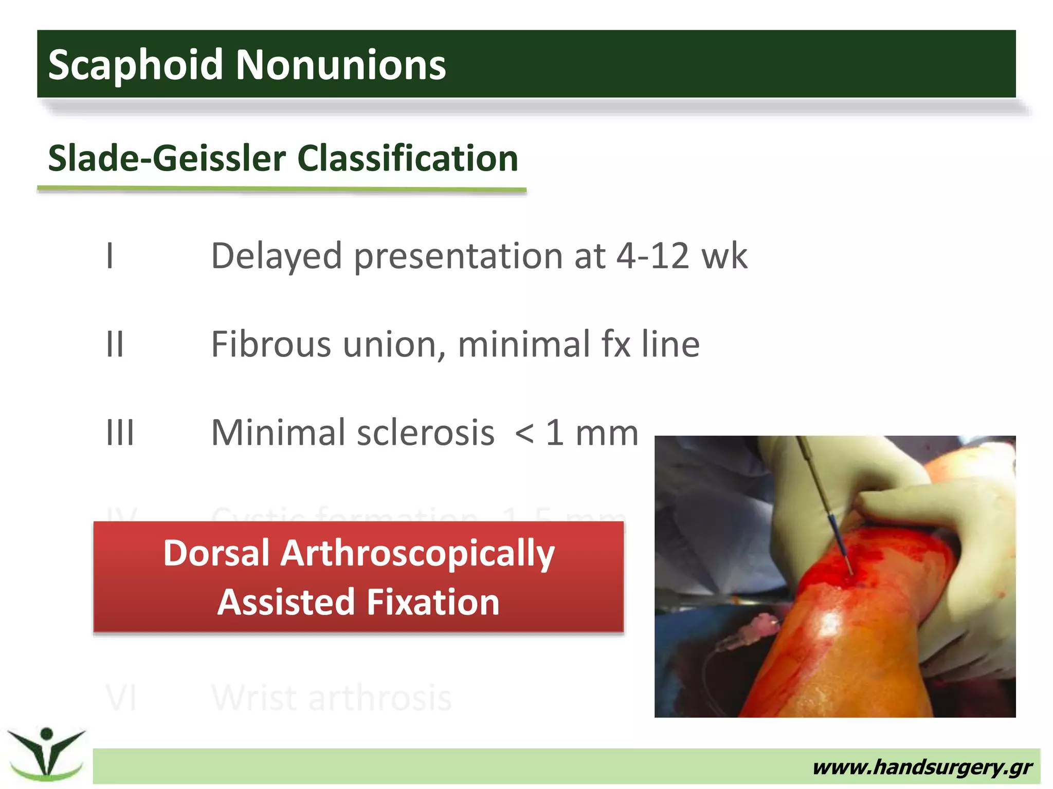 Arthroscopic treatment of scaphoid fractures & nonunions | PPTX