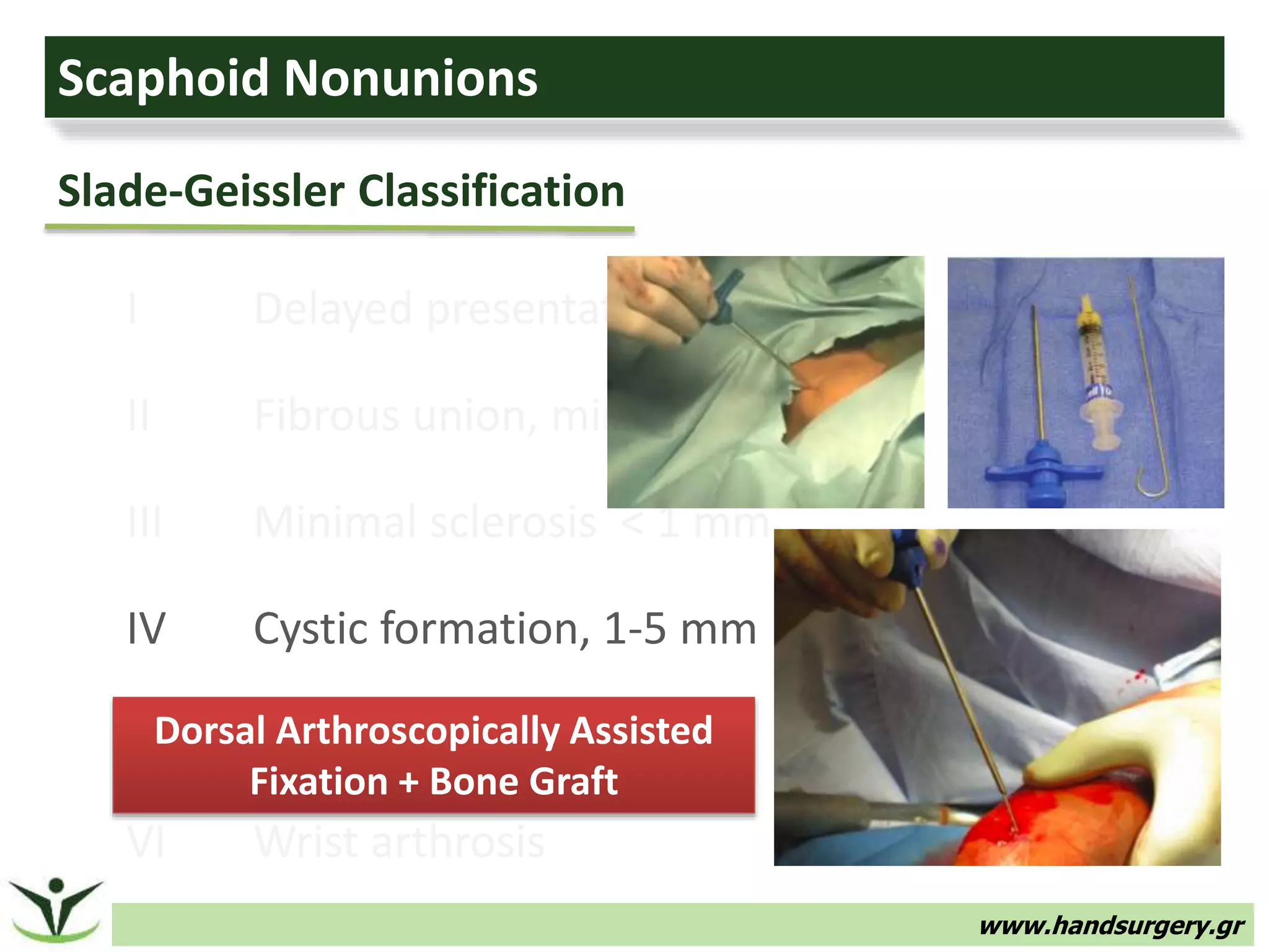 Arthroscopic treatment of scaphoid fractures & nonunions | PPTX