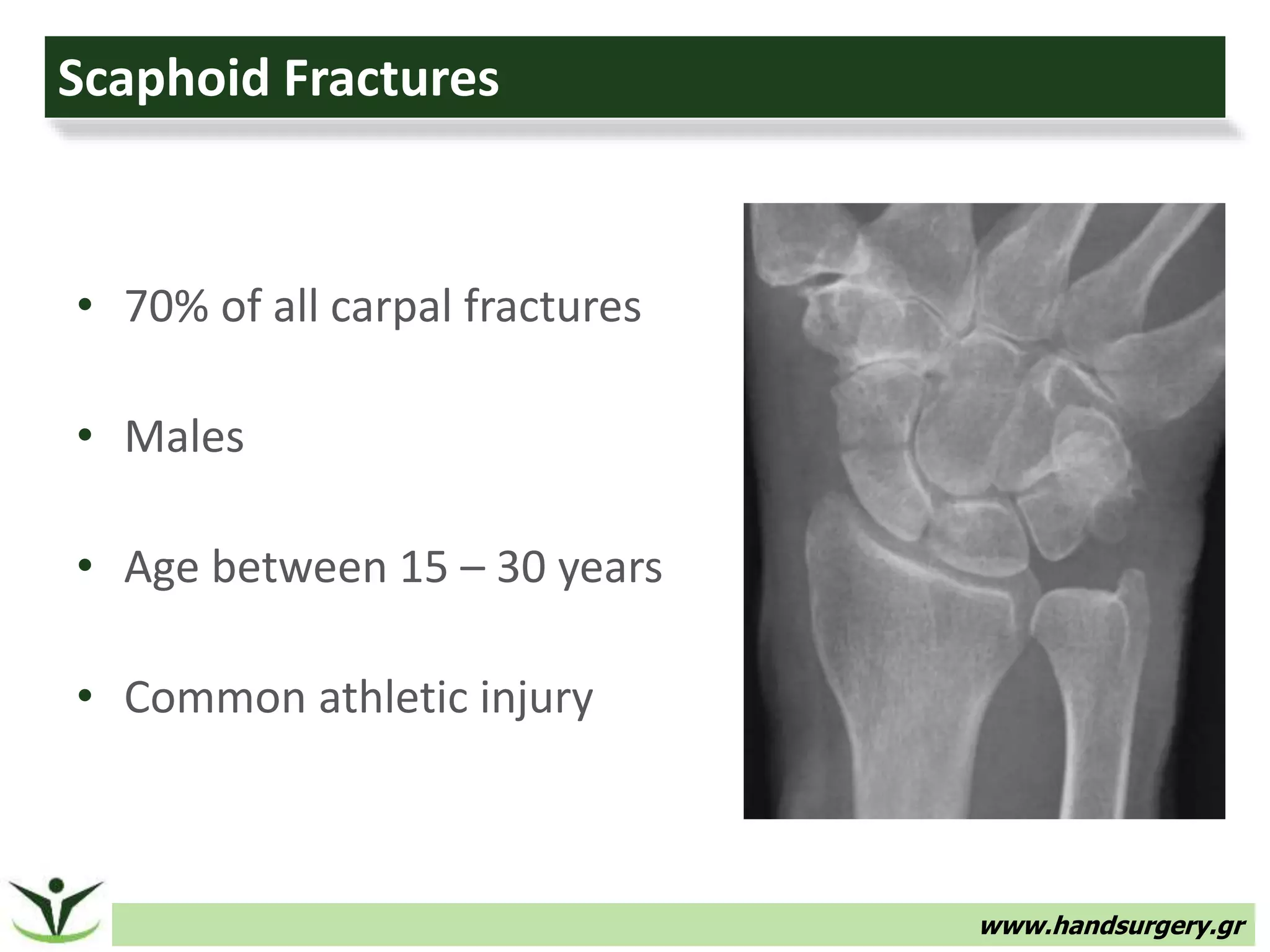 Arthroscopic treatment of scaphoid fractures & nonunions | PPTX