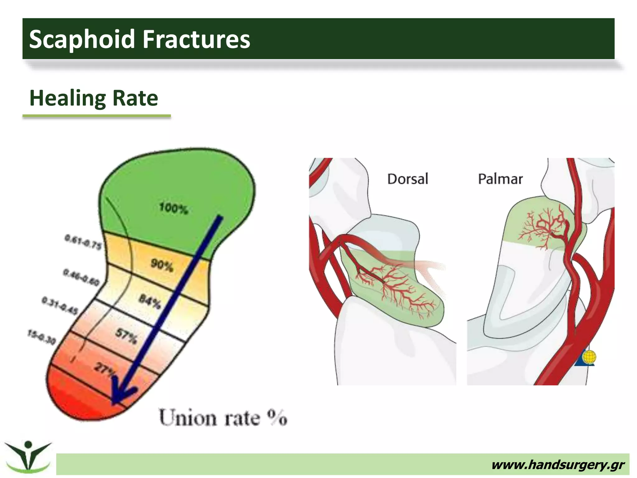 Arthroscopic treatment of scaphoid fractures & nonunions | PPT