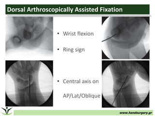 Arthroscopic treatment of scaphoid fractures & nonunions | PPTX