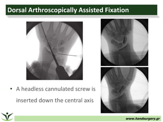 Arthroscopic treatment of scaphoid fractures & nonunions | PPTX