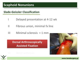 Arthroscopic treatment of scaphoid fractures & nonunions | PPTX