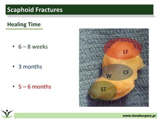 Arthroscopic treatment of scaphoid fractures & nonunions | PPTX