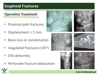 Arthroscopic treatment of scaphoid fractures & nonunions | PPTX