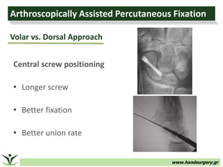 Arthroscopic treatment of scaphoid fractures & nonunions | PPTX
