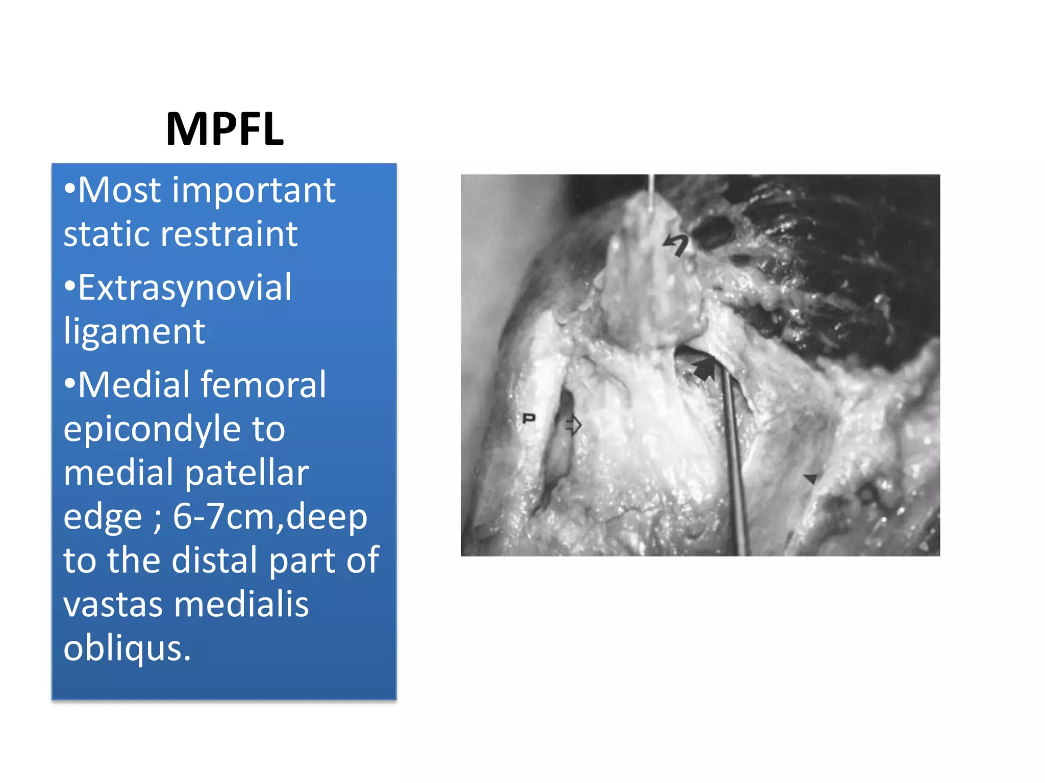 Arthroscopy assisted mpfl reconstruction | PPT