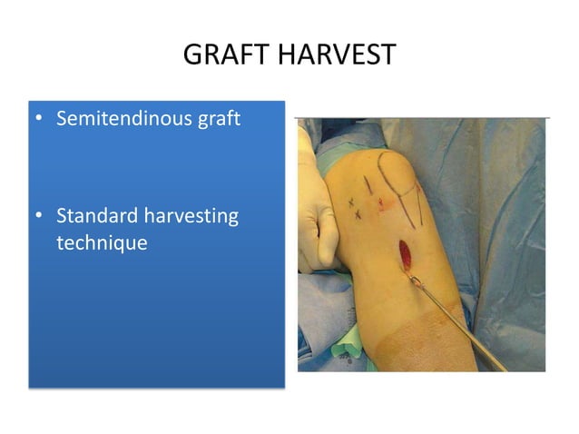 Arthroscopy assisted mpfl reconstruction | PPT