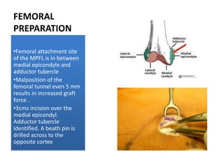 Arthroscopy assisted mpfl reconstruction | PPT