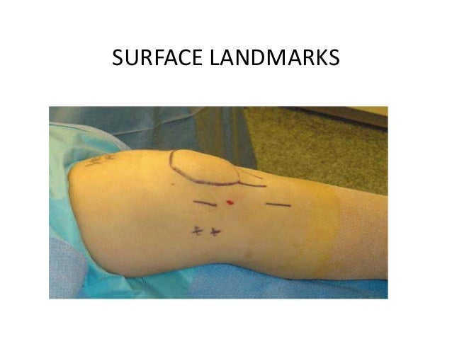 Arthroscopy assisted mpfl reconstruction