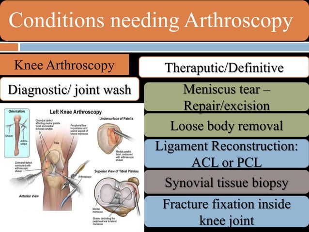 Arthroscopy key hole surgery | PPTX