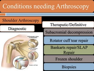 Arthroscopy key hole surgery | PPTX