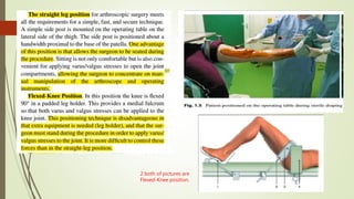Arthroscopy of the knee | PPTX