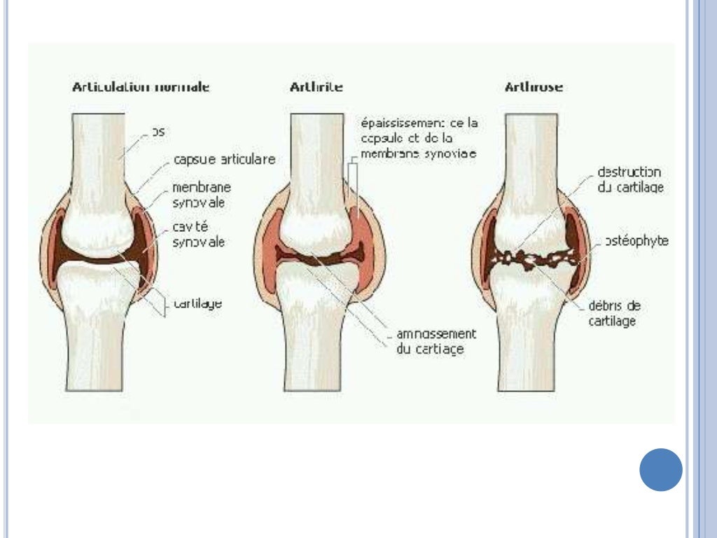 Quelques Conseils Pour Différencier LArthrose De LArthrite - Archeologie