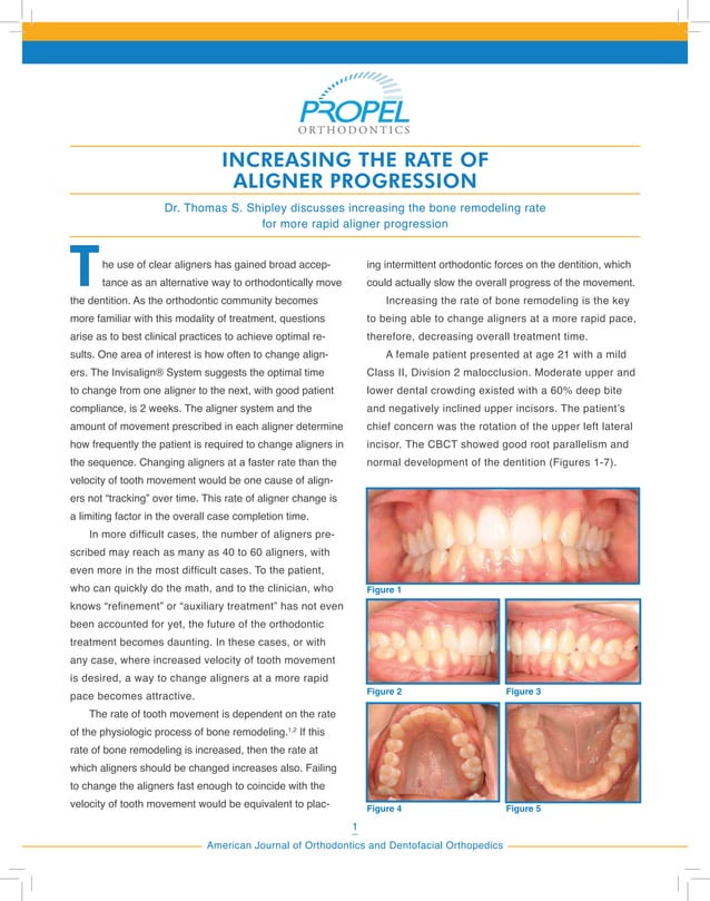 Article shipley increasing rate of aligner progression | PDF