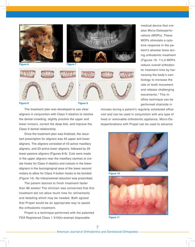 Article shipley increasing rate of aligner progression | PDF