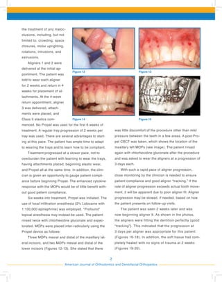 Article shipley increasing rate of aligner progression | PDF