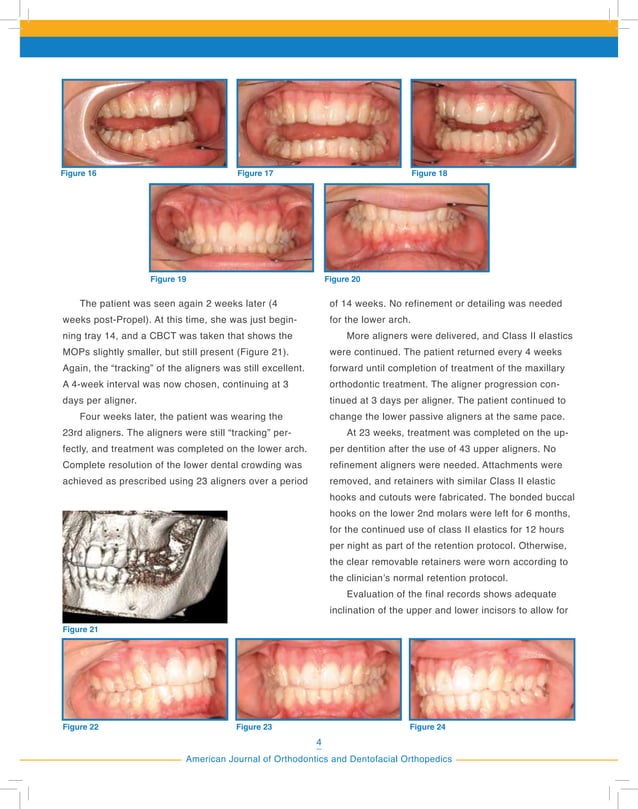 Article shipley increasing rate of aligner progression | PDF