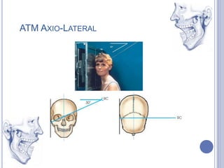 Articulación temporomandibular hepot,,, | PPTX