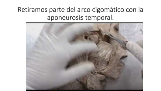 Articulacion temporo mandibular | PPTX