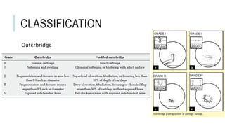 Articular cartilage injury | PPTX
