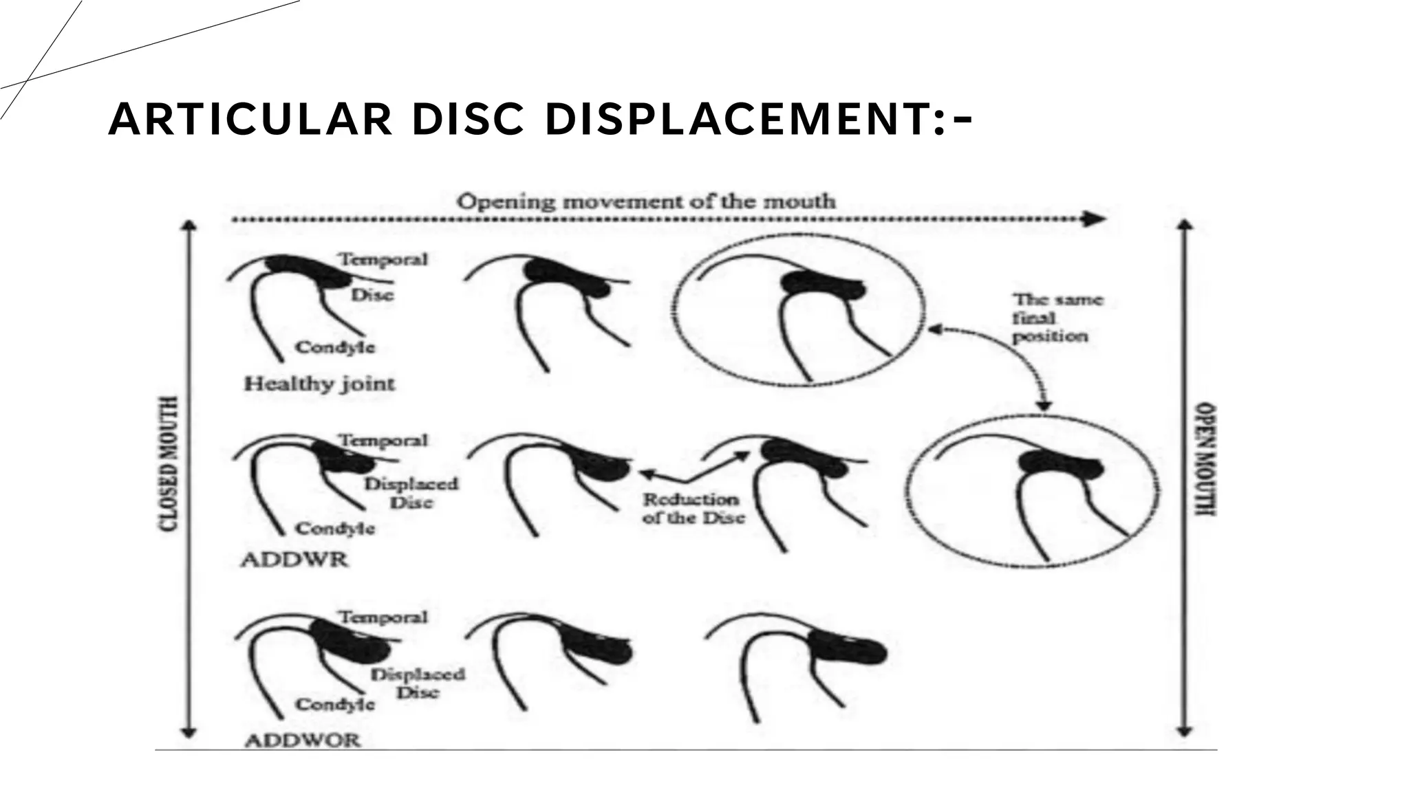 ARTICULAR DISC OF TEMPOROMANDIBULAR JOINT | PDF