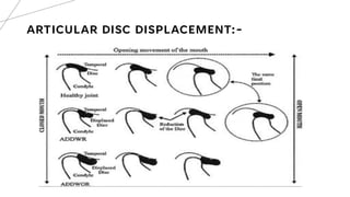 ARTICULAR DISC OF TEMPOROMANDIBULAR JOINT | PDF