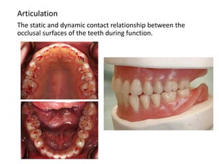 Articulators in Prosthodontics | PPTX