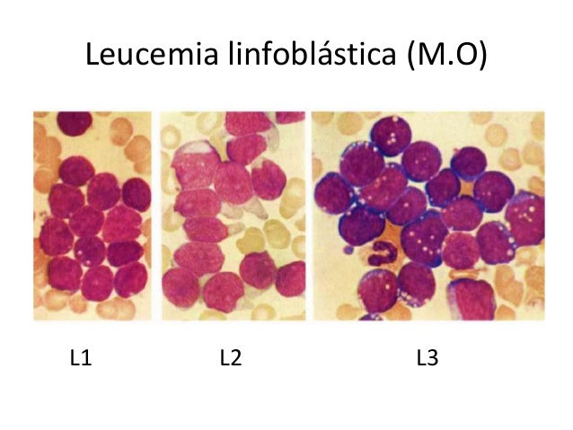 clasificacion leucemias FAB