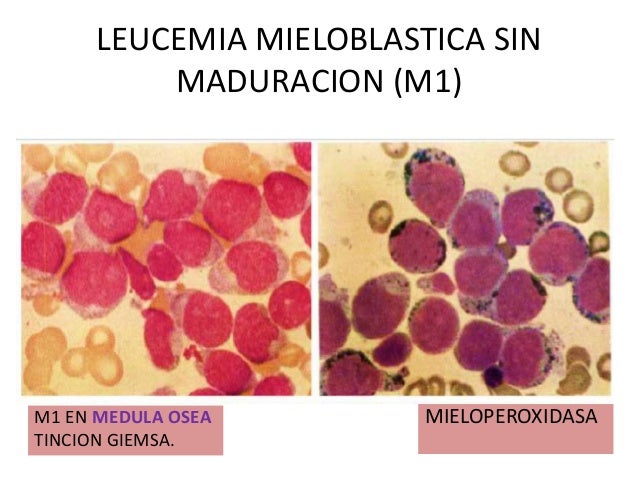 clasificacion leucemias FAB