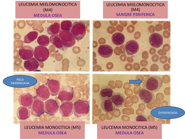 clasificacion leucemias FAB