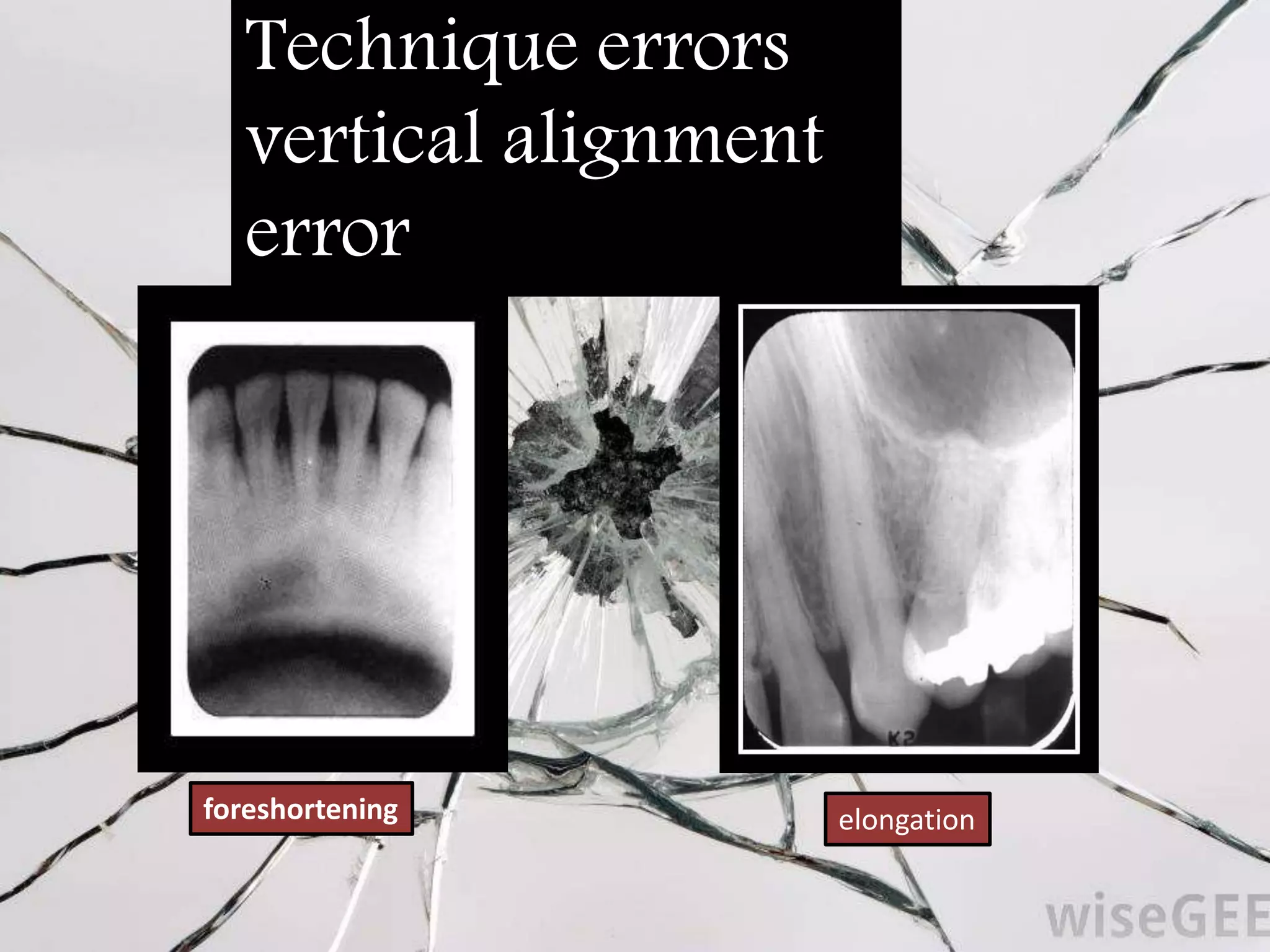 Artifact and errors in intraoral periapical radiograph.ppt