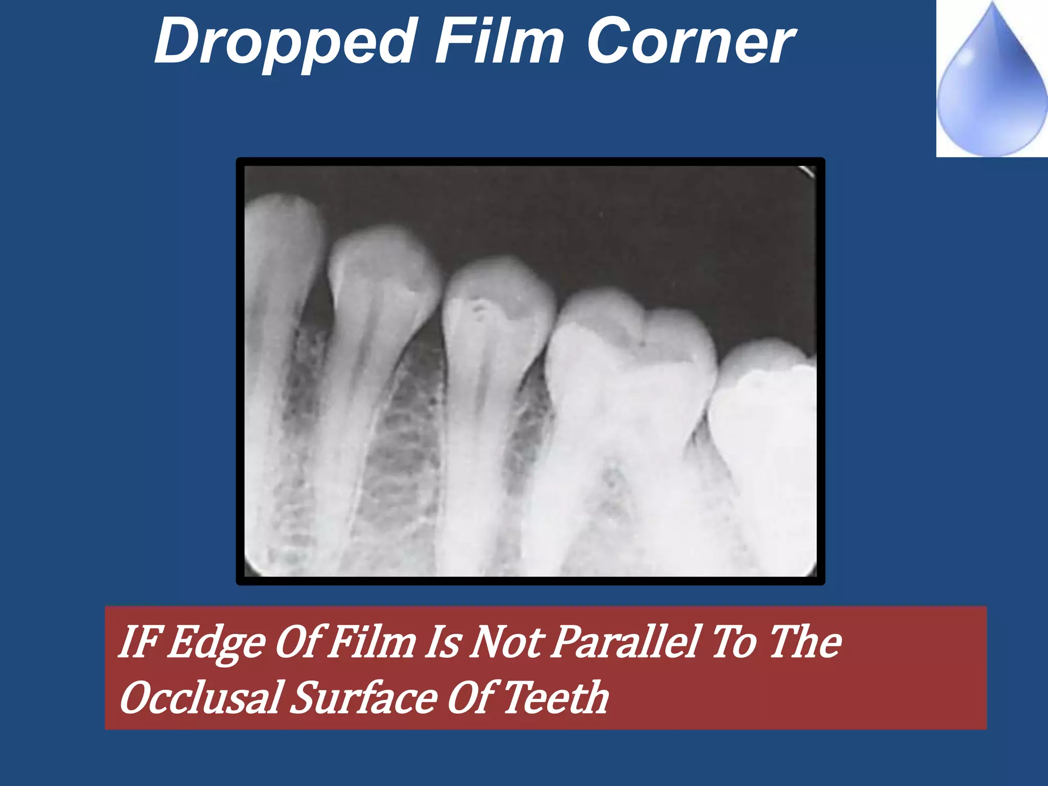 Artifact and errors in intraoral periapical radiograph.ppt