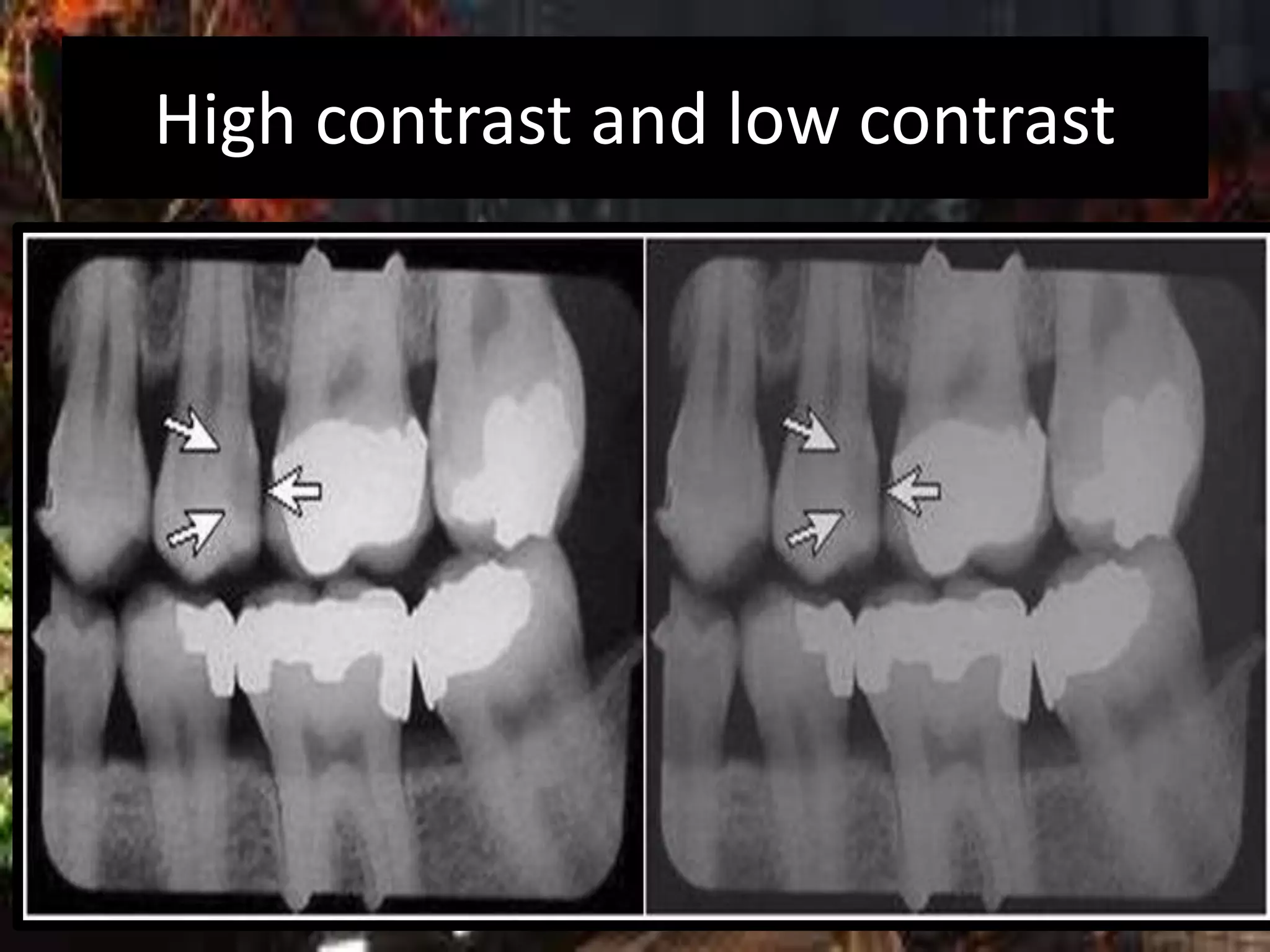 Artifact and errors in intraoral periapical radiograph.ppt
