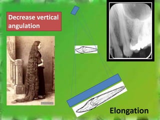 Artifact and errors in intraoral periapical radiograph.ppt