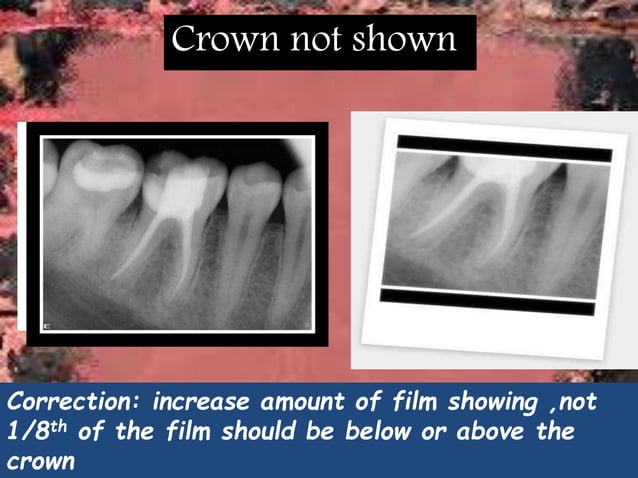 Artifact and errors in intraoral periapical radiograph.ppt ...