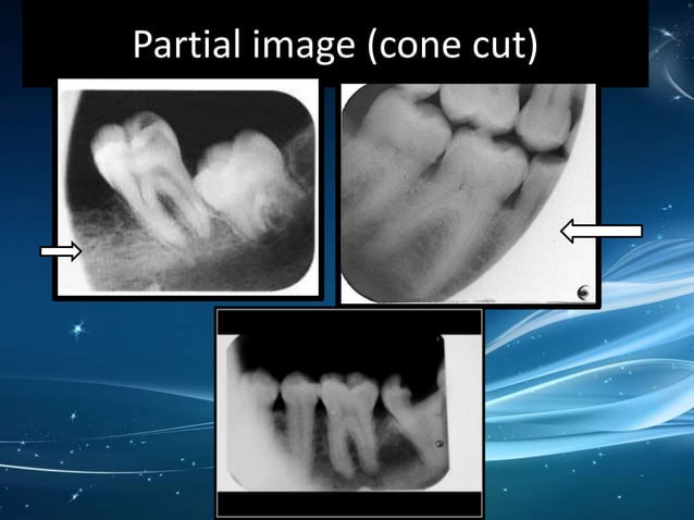 Artifact and errors in intraoral periapical radiograph.ppt ...