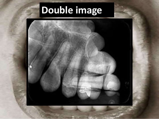 Artifact and errors in intraoral periapical radiograph.ppt