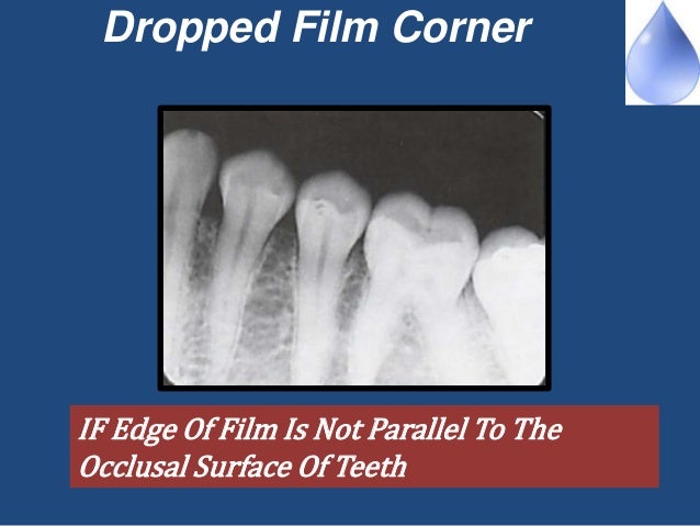 Artifact and errors in intraoral periapical radiograph.ppt