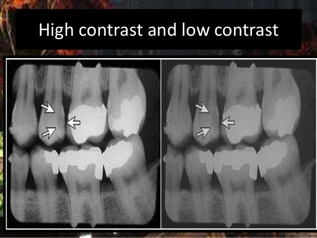 Artifact and errors in intraoral periapical radiograph.ppt