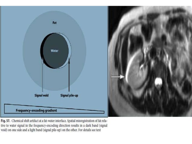 MRI Artifact Radiology | PPTX | Medical Tests | Medical Health