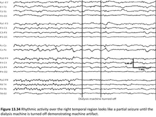 Artifact of nonphysiologic origin | PPT