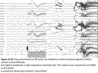 Artifact of nonphysiologic origin | PPT