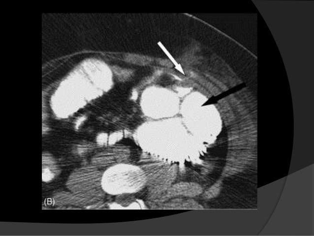 Contrast based artifacts