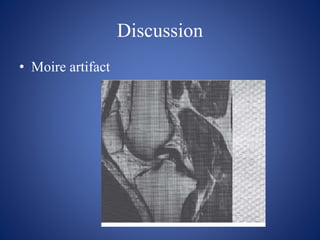 Morie Artifact Mri