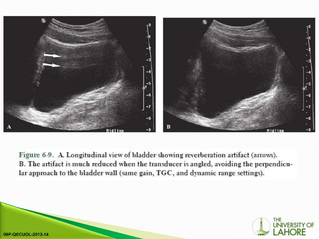 Artifacts in Ultrasound.pptx( by Jalil Hanafi) | PPTX | Digital Audio | Computer Software and ...