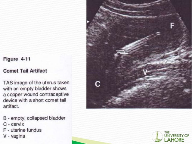 Artifacts in Ultrasound.pptx( by Jalil Hanafi) | PPTX | Digital Audio | Computer Software and ...