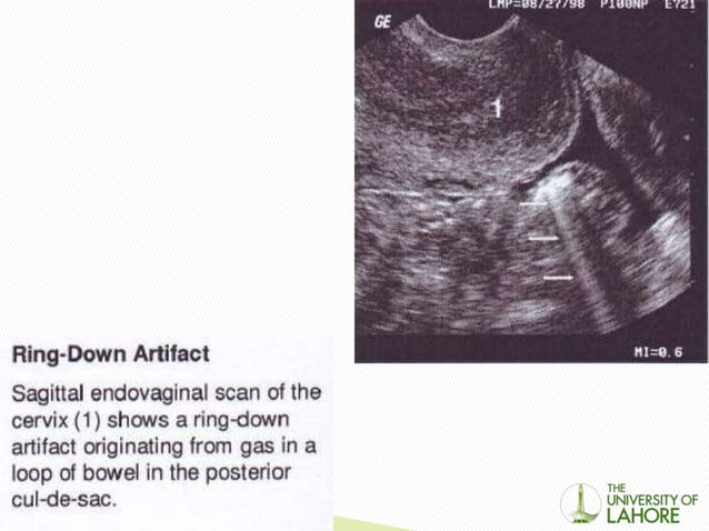 Artifacts in Ultrasound.pptx( by Jalil Hanafi) | PPTX | Digital Audio | Computer Software and ...